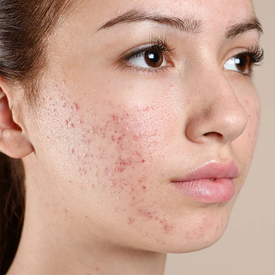 Acne SkinInspire Acne SkinInspire